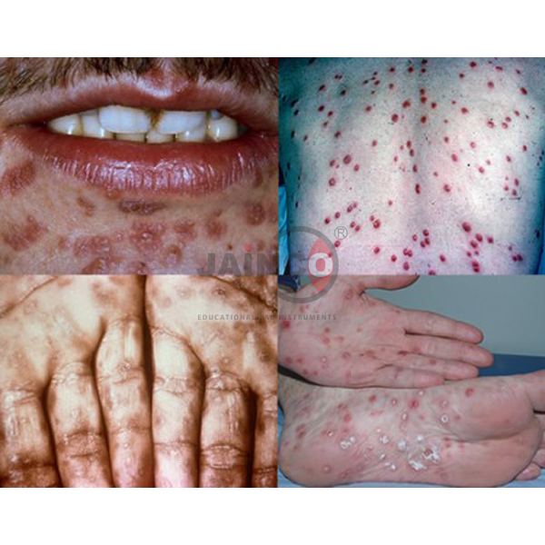 Clinical Stages of Untreated Syphilis Model Manufacturers, Supplier ...